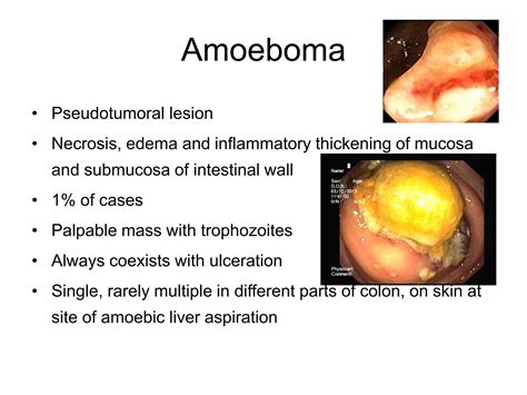 Amoebiasis Pptx