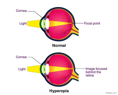 Hyperopia Causes Symptoms And Correction Methods