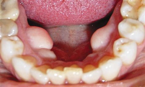 Mandibular Tori Causes Symptoms And Removal Dental 3du