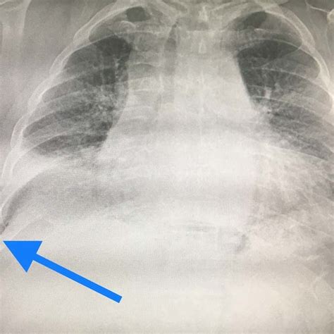 Pdf Lung Herniation Through The Thoracic Wall After Persistent