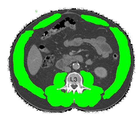 A Cross Sectional Computed Tomography Ct Image At The Third Lumbar Download Scientific