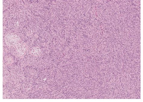 Myoid Gonadal Stromal Tumour Download Scientific Diagram
