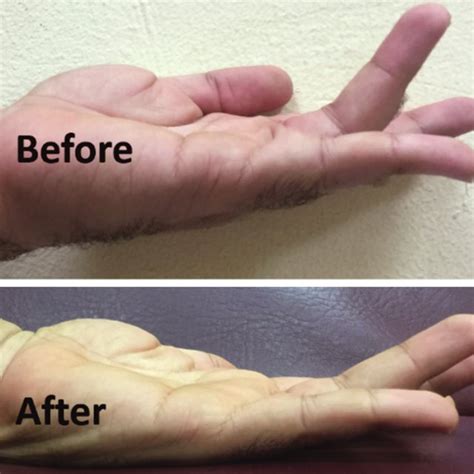 Lateral View Show Improvement Of Flexion Deformity Of Left Mcp Joint Of Download Scientific