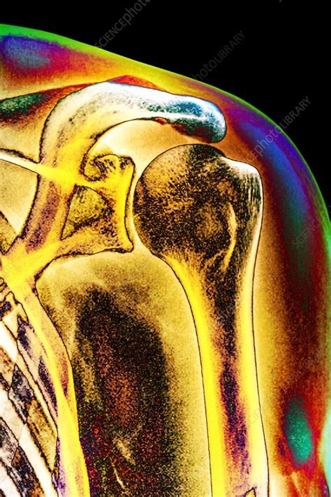 Is Shoulder Joint Healthy Glenohumeral Joint Effusion Obaulw