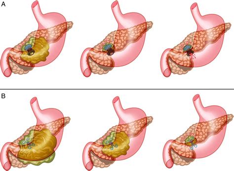 Illustration Of The Concept Of Delayed Bleeding With The Use Of