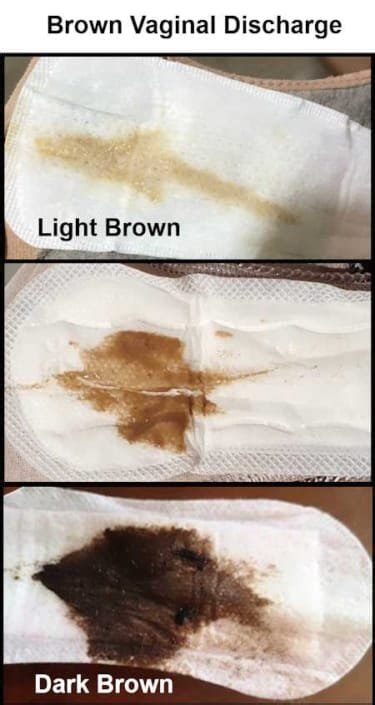 Brown Vaginal Discharge Causes Treatment And When To Get Tested