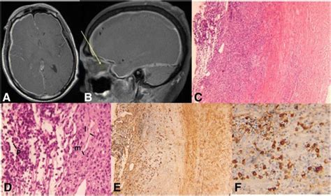 Neuroimaging And Histopathology Of Case 2 A T1 Axial Post Contrast