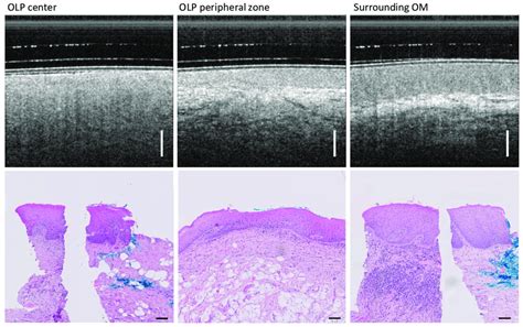 Patient Iv With Diagnosed Reticular Atrophic Olp Comparison Of Oct