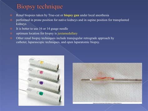 Interpretation Of Renal Biopsy Pptx