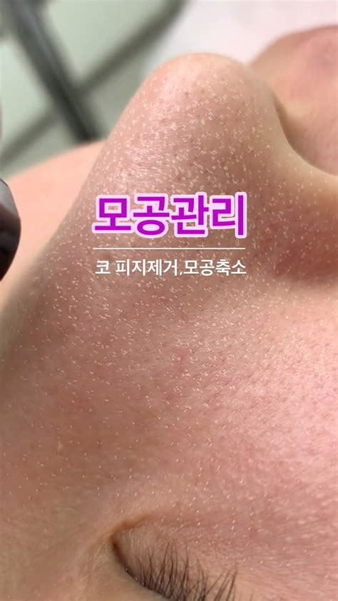 마이크로젯 X 바이오폭스 블랙헤드는 물론 나비존 모공까지 모두 소멸해드립니다 주름개선 피부재생 피부차오름 피부톤개선화이트닝 피부탄력강화 피부장벽강화 기미완화