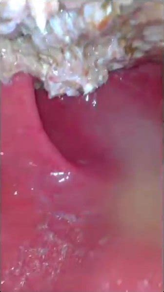 Girl Swallows Endoscope With Full Stomach Part 2 日本語で