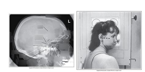 Lateral Diagram Quizlet