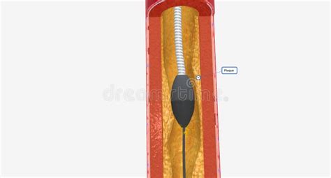 Atherectomy Is A Minimally Invasive Procedure That Removes Plaque Using A Catheter With A Drill