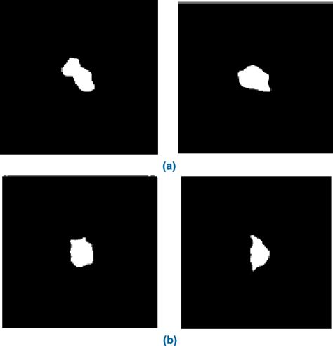 Figure 12 From Classification Of Benign And Malignant Pulmonary Nodules Based On The