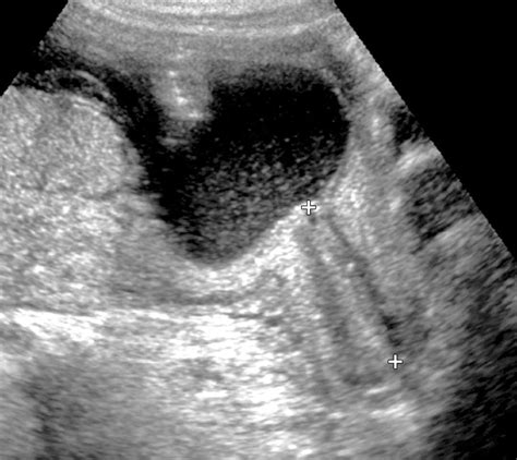Cervical Ultrasound And Preterm Birth Clinical Tree