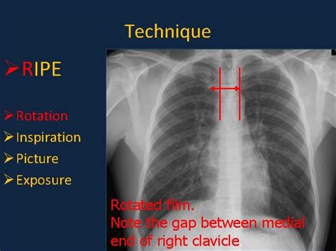 Part 2 0 Standardised Interpretation Of Paediatric Cxr