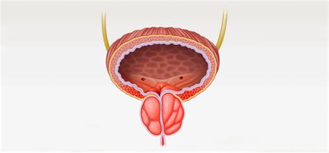 Prostate Artery Embolization For Benign Prostatic Hyperplasia Ircc Pakistan