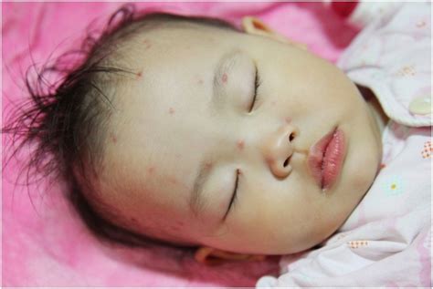 수두 초기증상 이럴땐 의심하세요 네이버 블로그