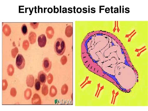 Erythroblastosis Fetalis Rh Incompatibility Youtube
