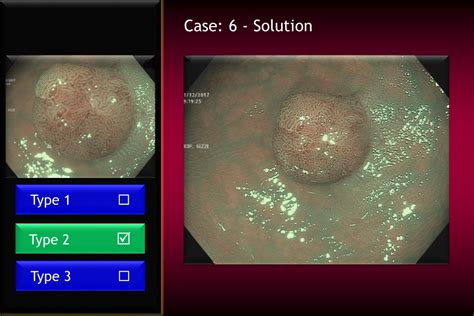 Nice Classification Colon Explorer