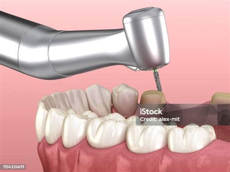 치과 용 크라운 배치를 위한 사전 몰 준비 공정 의학적으로 정확한 3d 그림 이빨에 대한 스톡 사진 및 기타 이미지 이빨 준비 0명 Istock