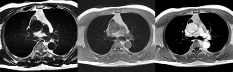 흉부 영상의학 서울대학교병원 영상의학과·서울대학교 의과대학 영상의학교실 홈페이지입니다