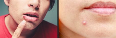 Cold Sore Vs Pimple How To Tell The Difference Luminance Red