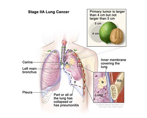 Lung Cancer Staging Cancer Care Centers Of Brevard