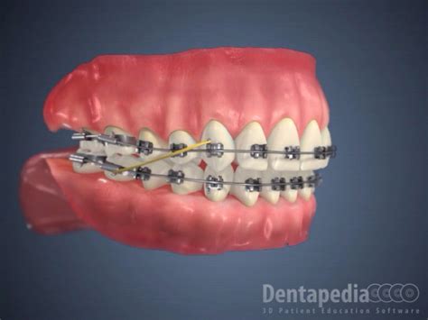 Class Ii Elastics In Orthodontics Gisele Garris