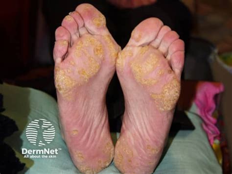 Punctate Type Palmoplantar Keratoderma