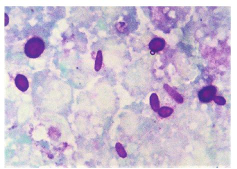 7 过碘酸 雪夫氏染色法 真菌感染性疾病直接镜检图谱