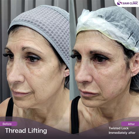 Thread Lift Before And After Photos Siam Clinic Thailand