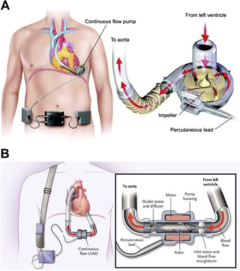 Non Pulsatile Ventricular Assist Devices