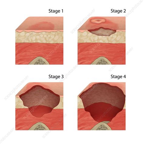 Pressure Ulcer Staging Nhs Pressure Ulcer Staging Guide Hndx