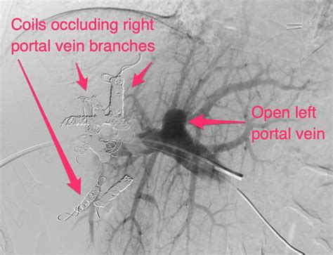 Portal Vein Embolization Advanced Liver Tumor Treatment Technique