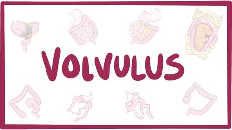Volvulus Video Causes And Meaning Osmosis
