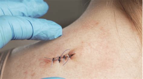 Dermatosurgery Dermatologist In Roorkee