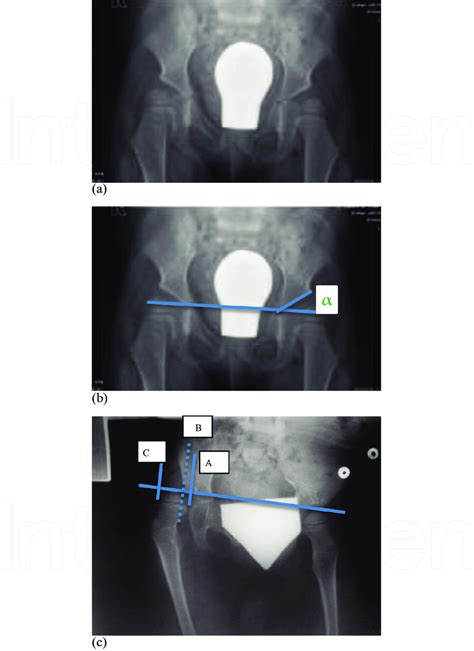 A Bilateral Head Coverage Insufficiency B Acetabular Index α C Download Scientific