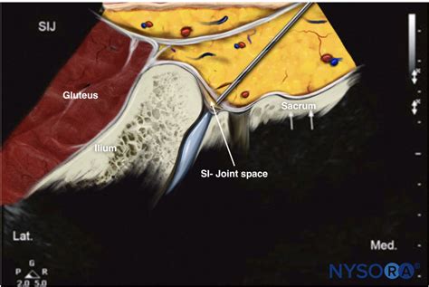 Sacroiliac Joint Injection Technique Sacroiliac Joint Injection Technique