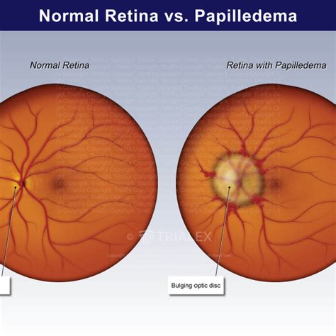 Normal Retina Vs Papilledema Trialexhibits Inc