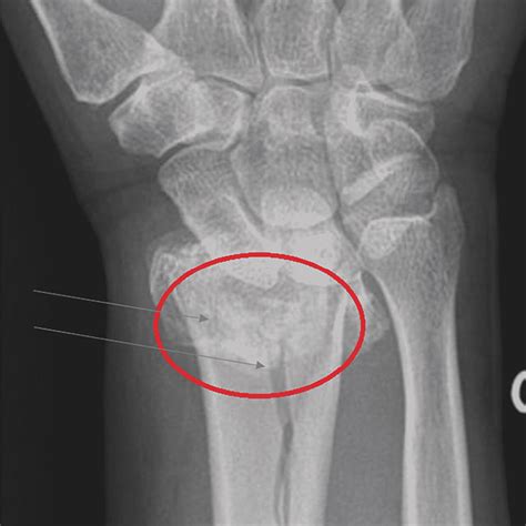 The Latest Methods Of Treating And Preventing Osteoporosis Dr Whats