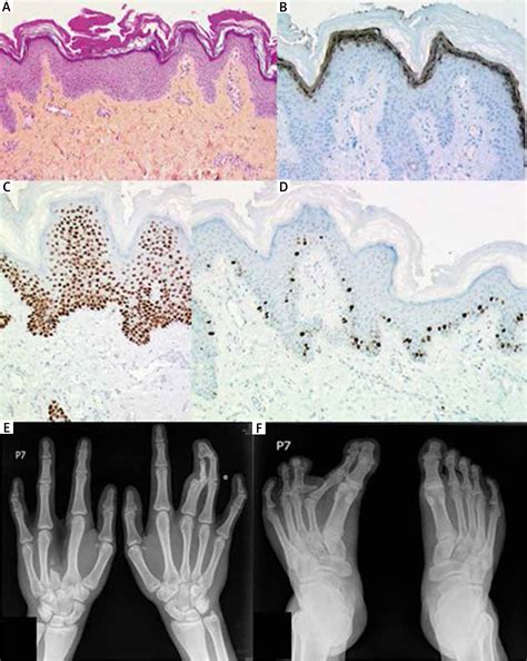 Ectrodactyly Ectodermal Dysplasia Clefting Syndrome With Unusual