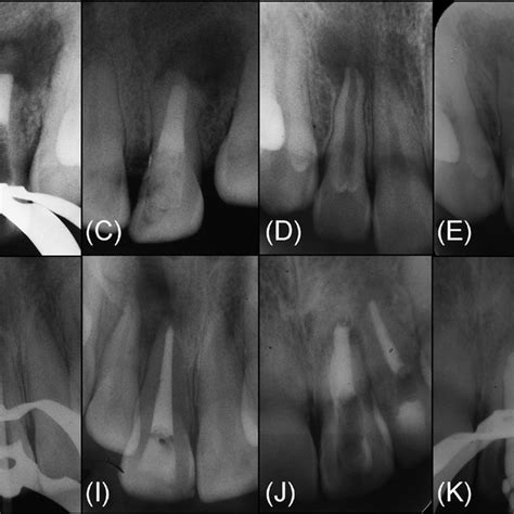 Schematic Of Cveks Stages Of Root Development A Group I