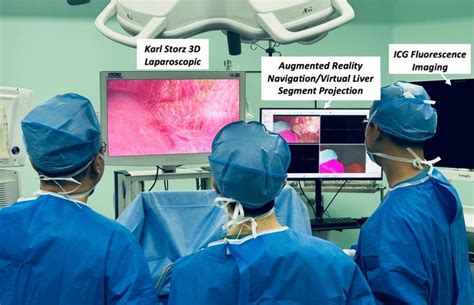 Stitches The General Surgery Newsletter On Linkedin Laparoscopic Left Hemihepatectomy Using