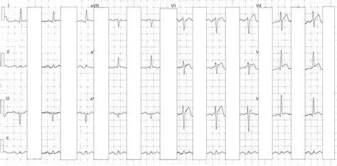 Ecg Case 089 • Litfl • Ecg Top 100 Self Assessment Quiz