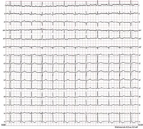Sample Ecg In The Ptb Dataset With Number S0001 Re Download Scientific Diagram