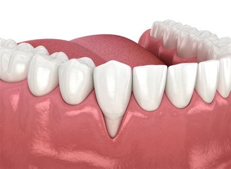 Gum Recession