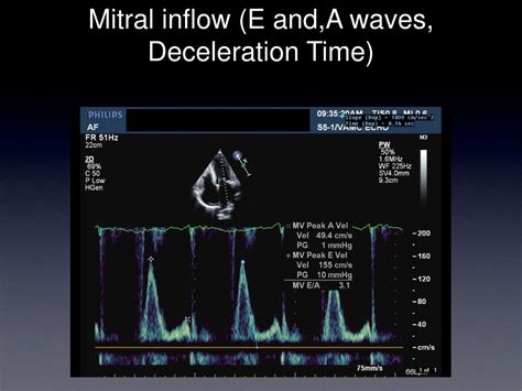 Ppt Ventricular Diastolic Filling And Function Powerpoint