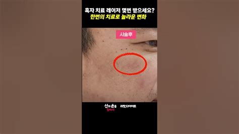 흑자치료 레이저 볓번 받으세요 한번의 치료로 놀라운 변화 Ft시술전후흑자제거검버섯없애기리팟레이저김혜진원장