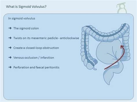 Sigmoid Volvulus Health Info Nurse Jackie Nurse